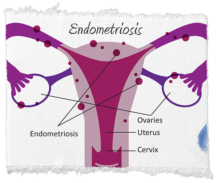 Endometriosis: Causes, Complications, and Treatments – namo magazine